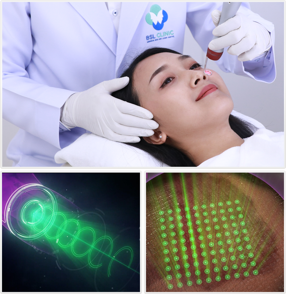 แก้ปัญหาผิว ฝ้า กระ จุดด่างดำ ลบรอยสัก ด้วย Pico Laser