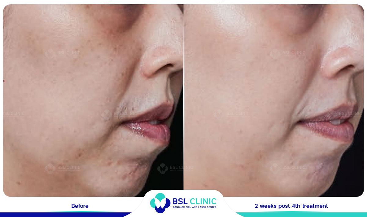 3 ข้อดี รักษาฝ้า กระ จุดด่างดำ ด้วย Program PicoWay Laser