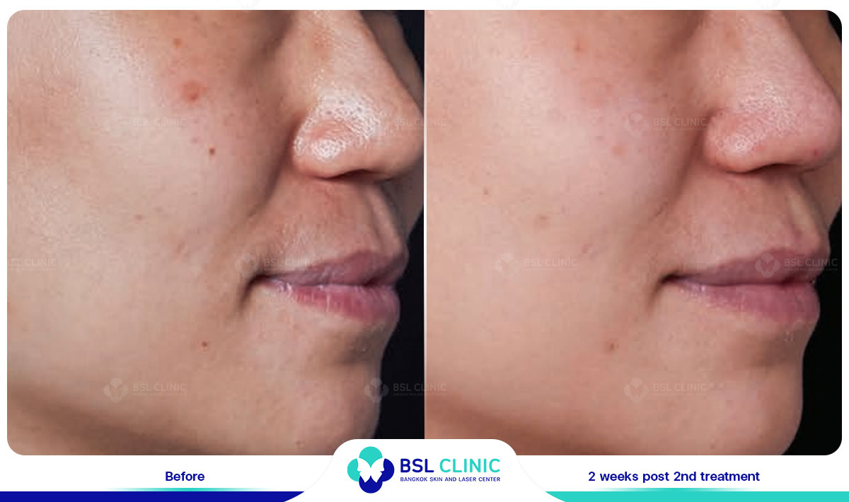 3 ข้อดี รักษาฝ้า กระ จุดด่างดำ ด้วย Program PicoWay Laser