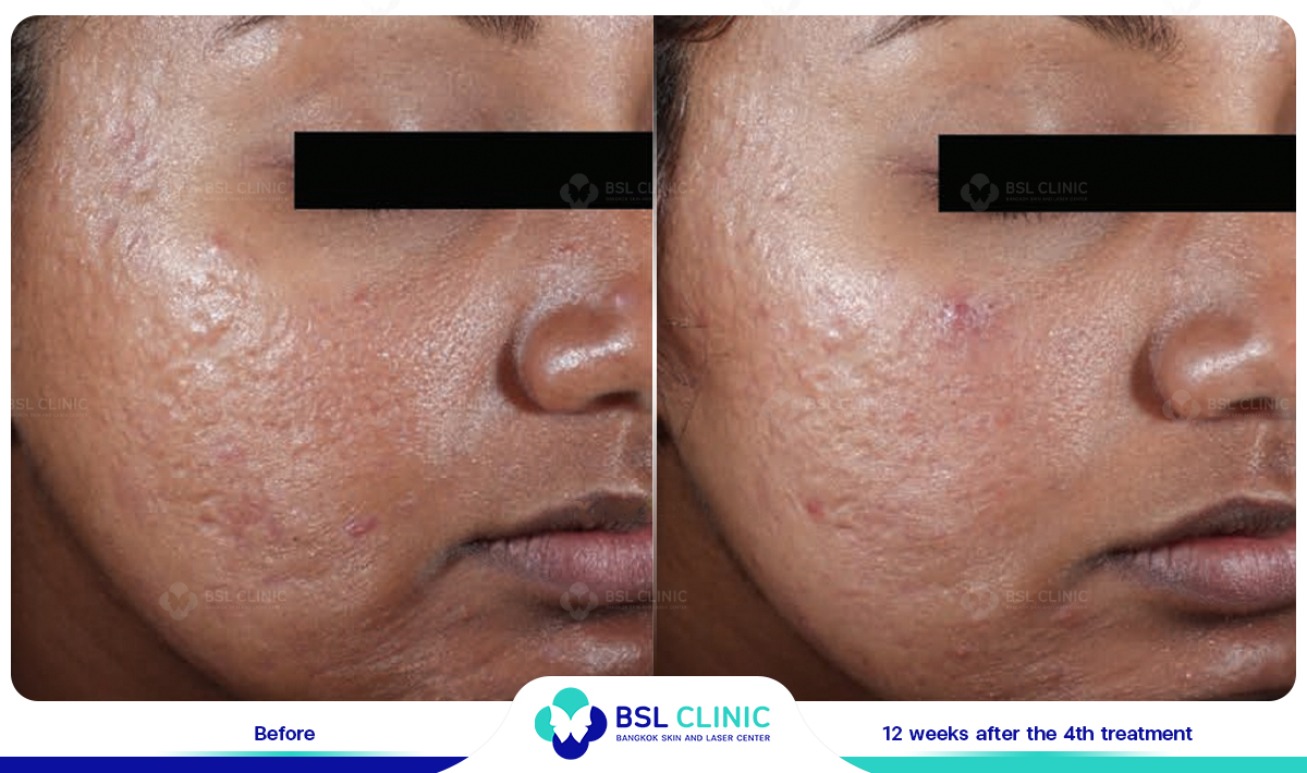 94% หลุมสิวตื้นขึ้น จบหลุมสิวด้วย PicoWay คืนผิวเรียบเนียน